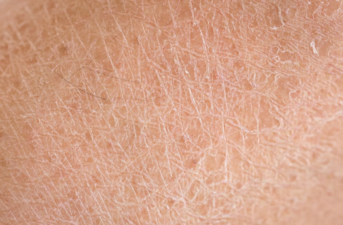Dry skin causes: how to identify and treat them? - Viara Clinics